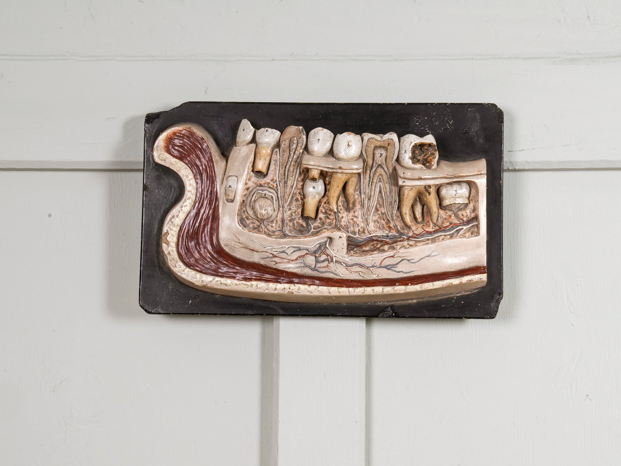 A 19th Century Plaster Didactic Model of Malformed Teeth – Drew ...
